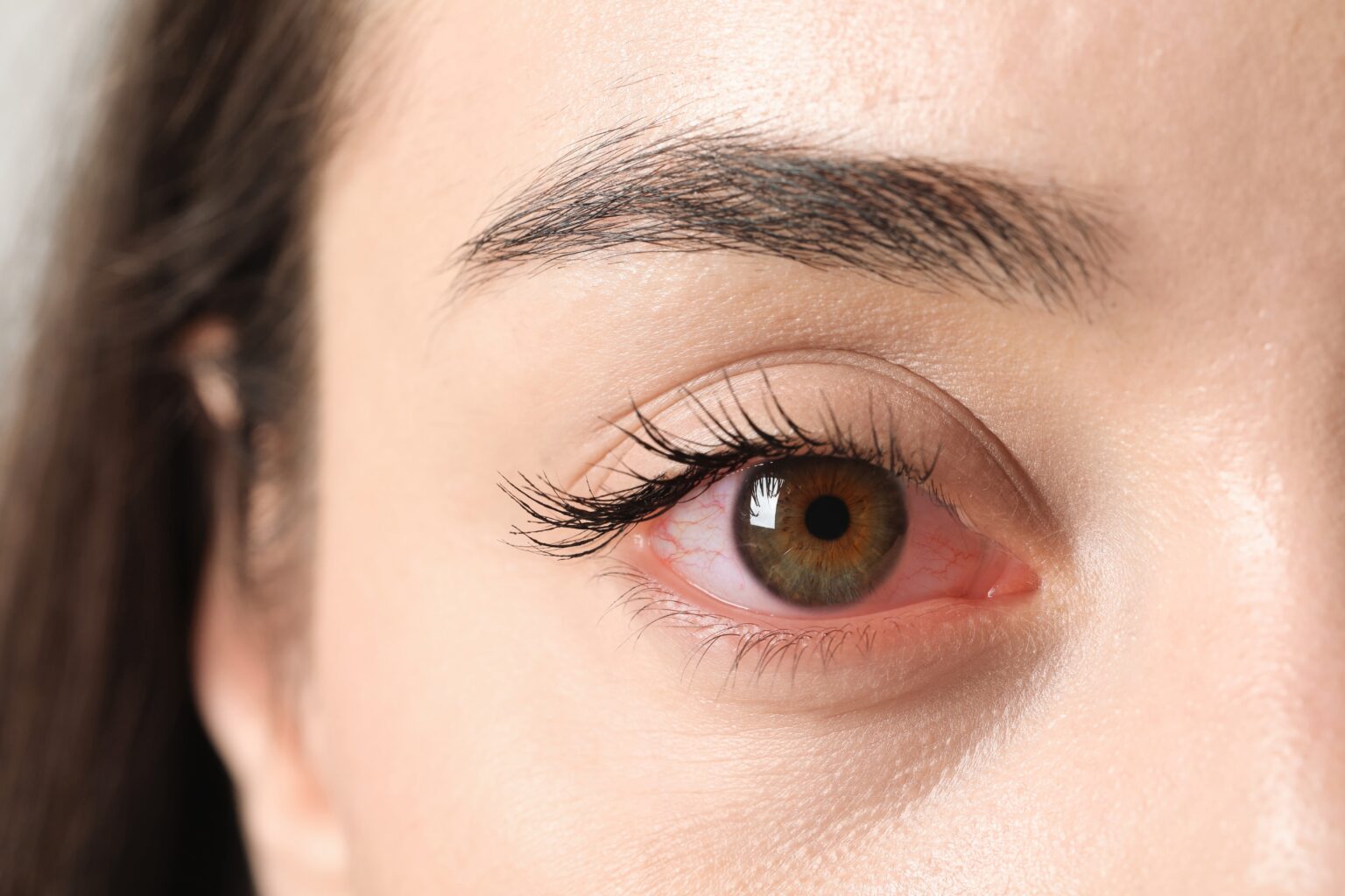 What Do I Do If My Eyes Are Red? - Simone Eye Center